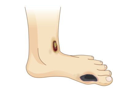 Cuts & Puncture Wounds: Risks, Prevention, and First Aid